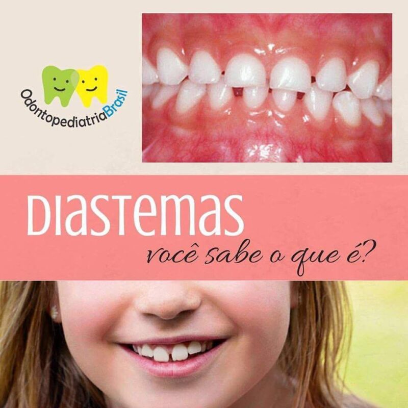 Diastemas, Você Sabe O Que É? – Odontopediatria Brasil
