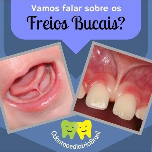 Freios Bucais – Odontopediatria Brasil