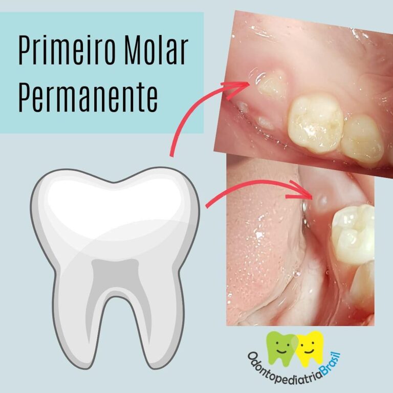 Primeiro Molar Permamente – Odontopediatria Brasil