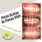 ?Pistas Diretas de Planas – Sabe o que é? – Odontopediatria Brasil