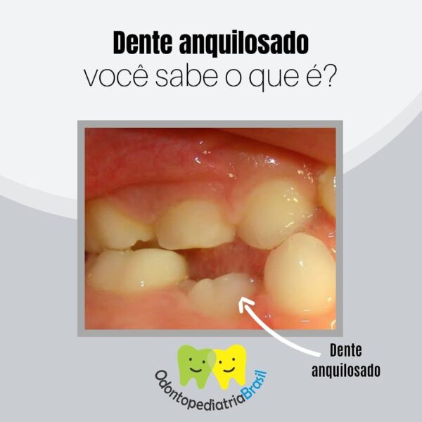 Nódulo de Bohn e Pérolas de Epstein – Odontopediatria Brasil